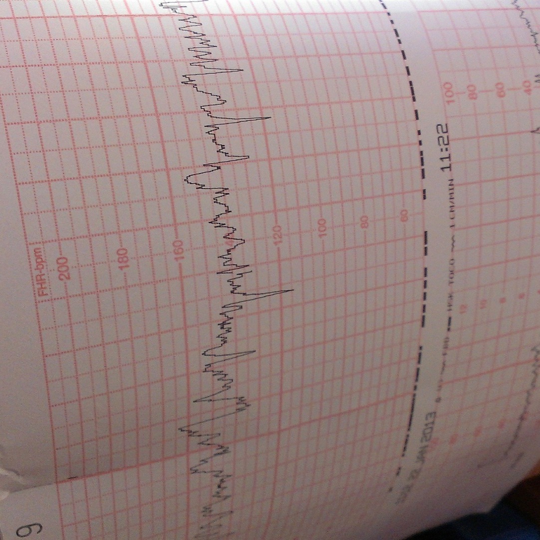 Fetal Heart Monitoring Errors Lawyer Grand Rapids, Michigan