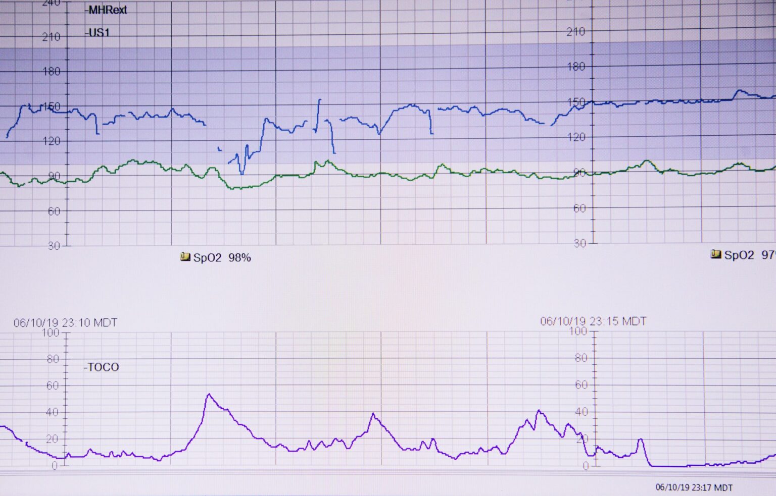 Fetal Monitoring: Why It’s Crucial During Pregnancy and Labor - Hoffer ...